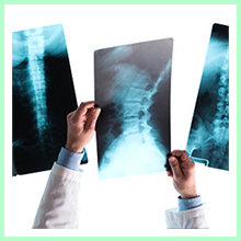 Peptite Preparations for the Treatment of Bechterew Syndrome