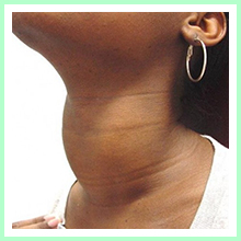 Peptide Preparations for the Treatment of Diffuse Toxic Goiter